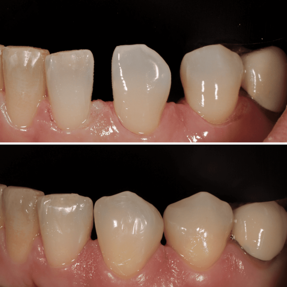 Direct Restorations - You - Clínica Dentária